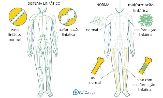 Malformações Linfáticas - tipos, causas, tratamento